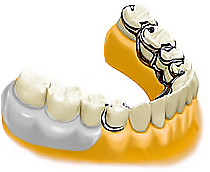 Klammerprothese | Bisswerk | günstiger Zahnersatz